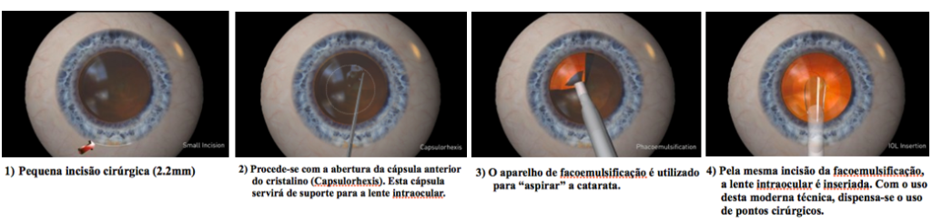 Cirurgia de Catarata: tudo o que você precisa saber – Gustavo Bonfadini