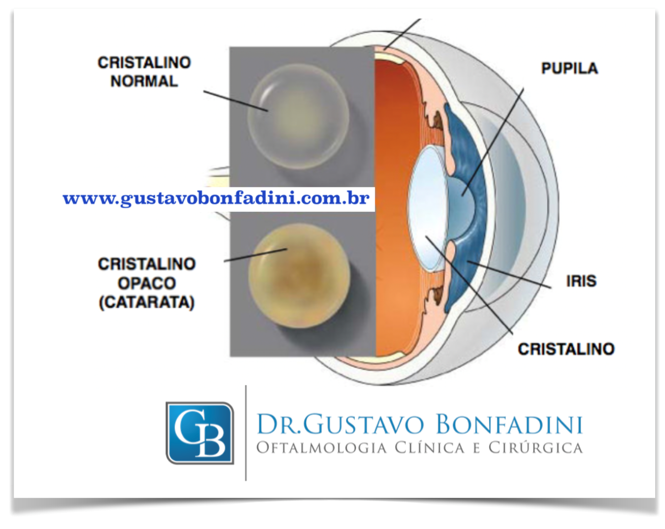 Cirurgia de Catarata: tudo o que você precisa saber – Gustavo Bonfadini