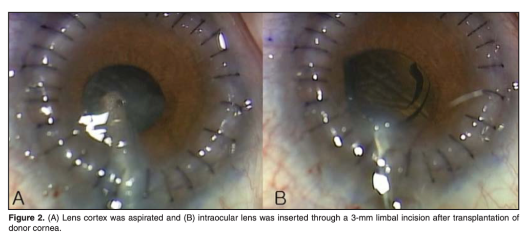 Avanço na Técnica de Transplante de Córnea com Cirurgia de Catarata ...
